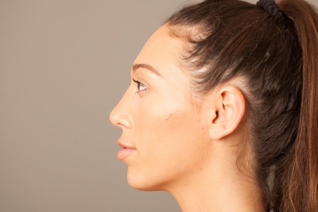 Dorsal Hump (Nose Bumps): Causes & Removal Options