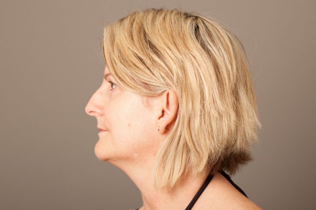 Dorsal Hump (Nose Bumps): Causes & Removal Options