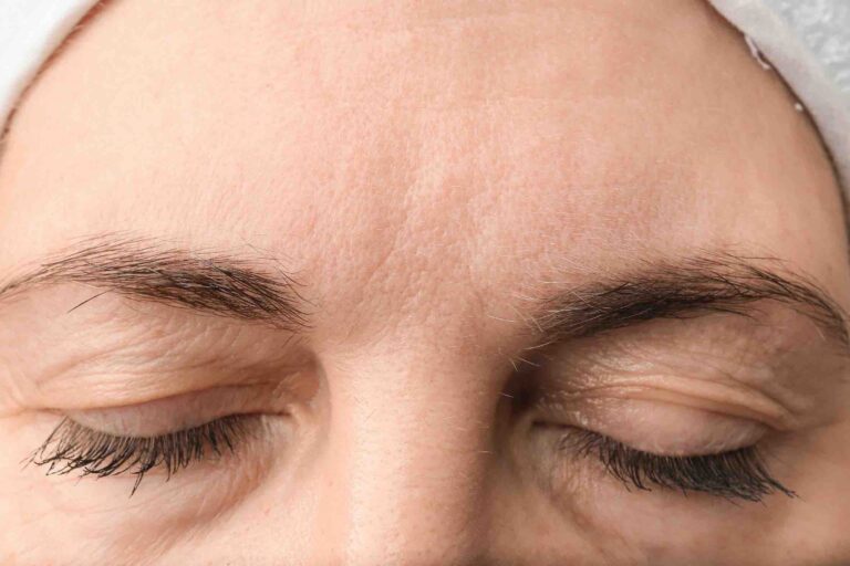 How to Fix Drooping Eyebrow | Plastic Surgeon Dr Mark Doyle