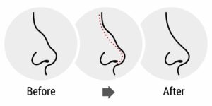 Dorsal Hump (Nose Bumps): Causes & Removal Options