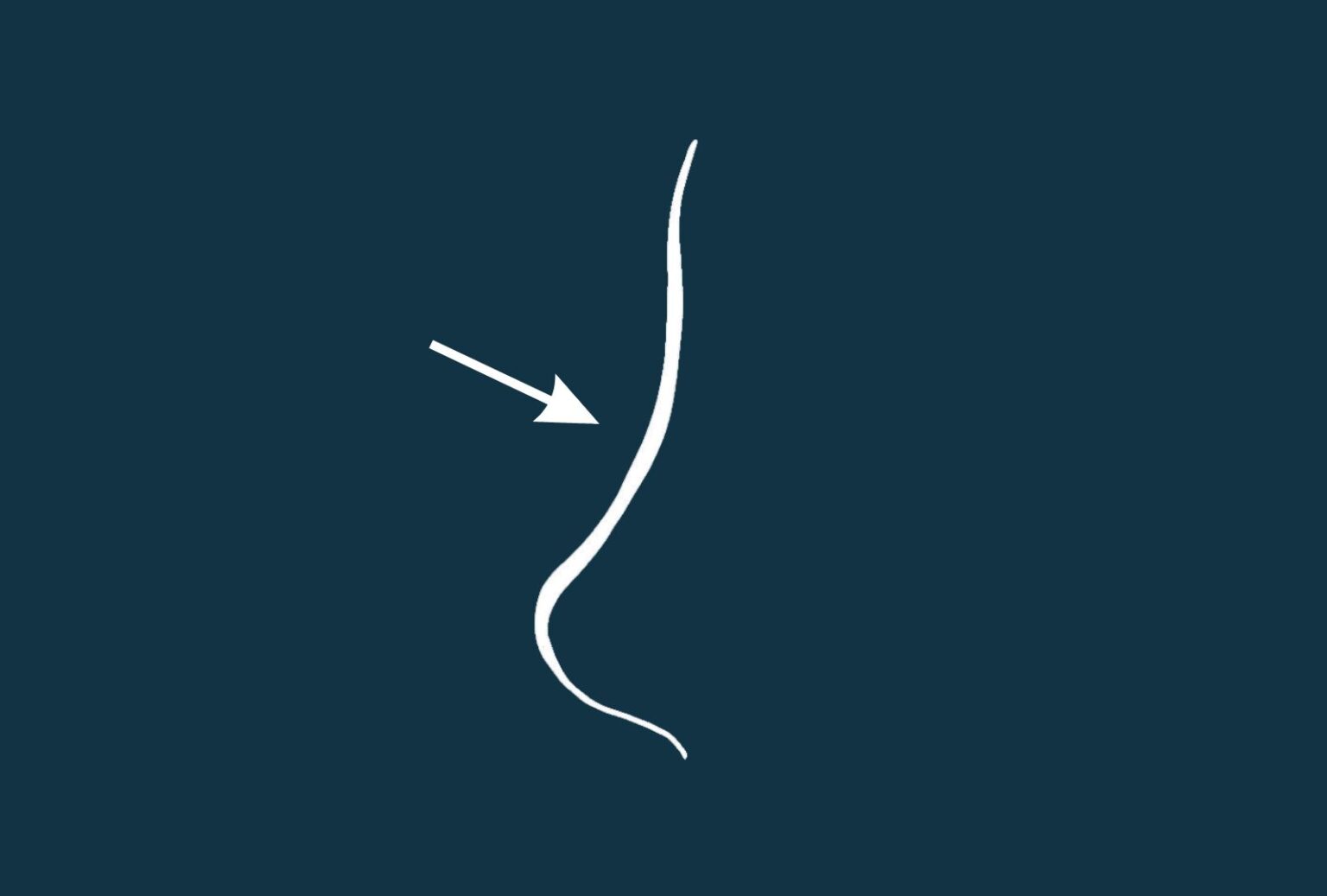 Understanding Saddle Nose: Causes, Symptoms, & Treatments