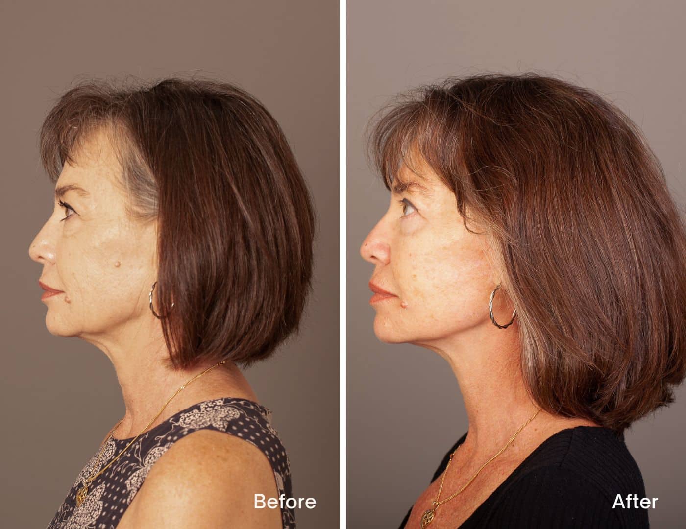 What to Expect from a Facelift Surgery | Gold Coast Specialist Plastic ...